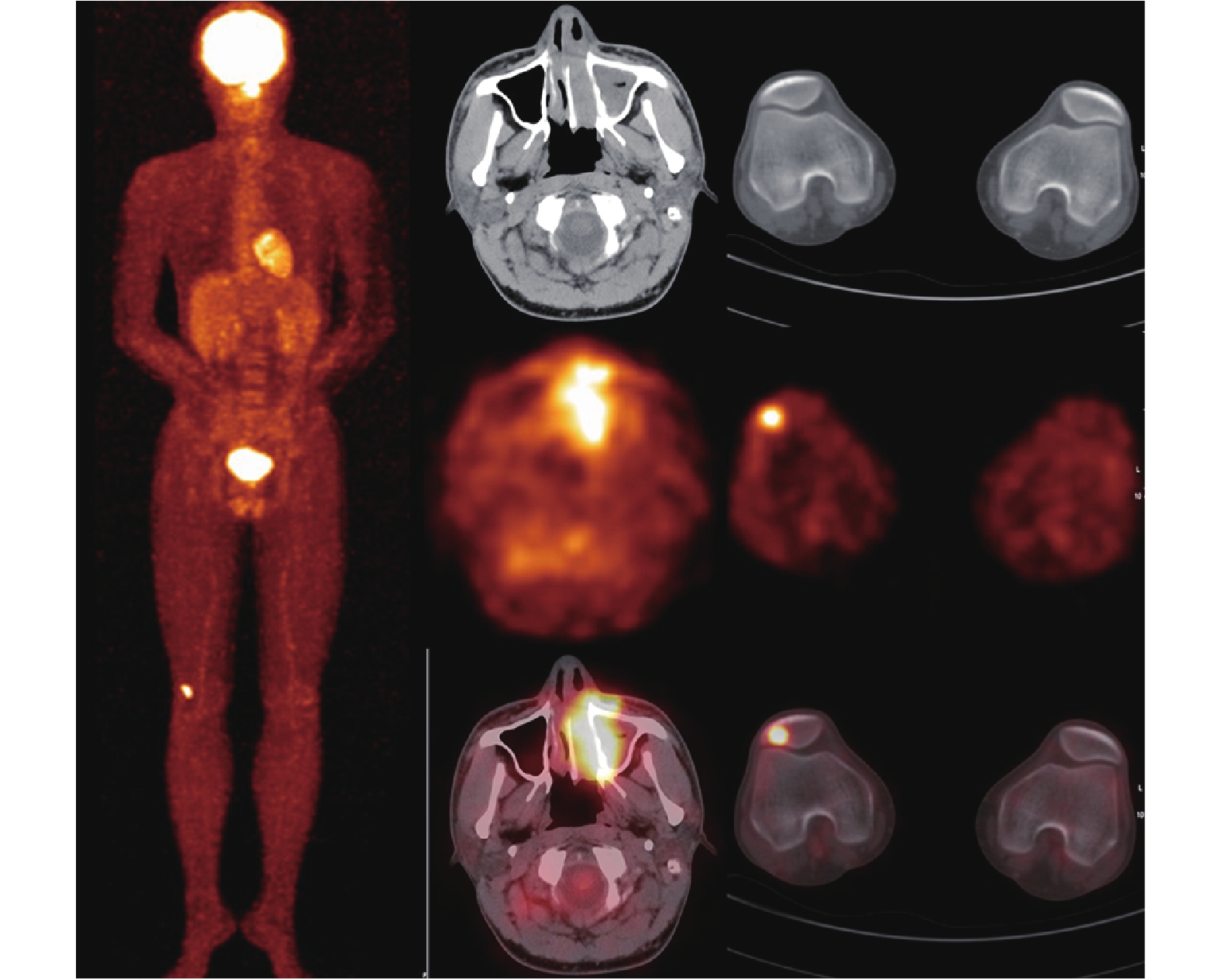 PET/CT真正全身显像在结外NK/T细胞淋巴瘤（鼻型）患者中的应用价值
