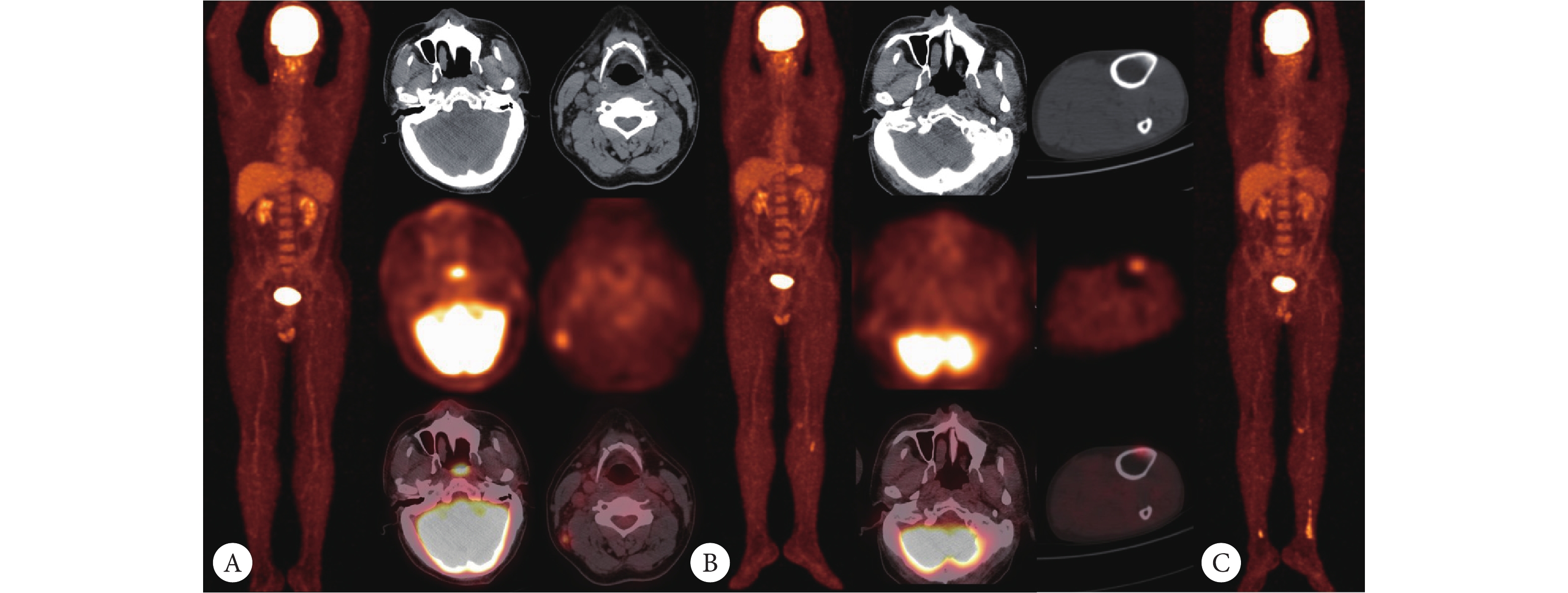 PET/CT真正全身显像在结外NK/T细胞淋巴瘤（鼻型）患者中的应用价值