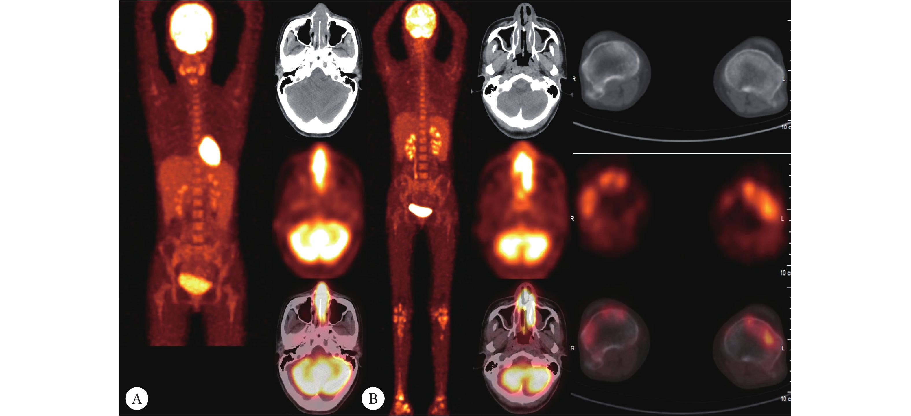 PET/CT真正全身显像在结外NK/T细胞淋巴瘤（鼻型）患者中的应用价值