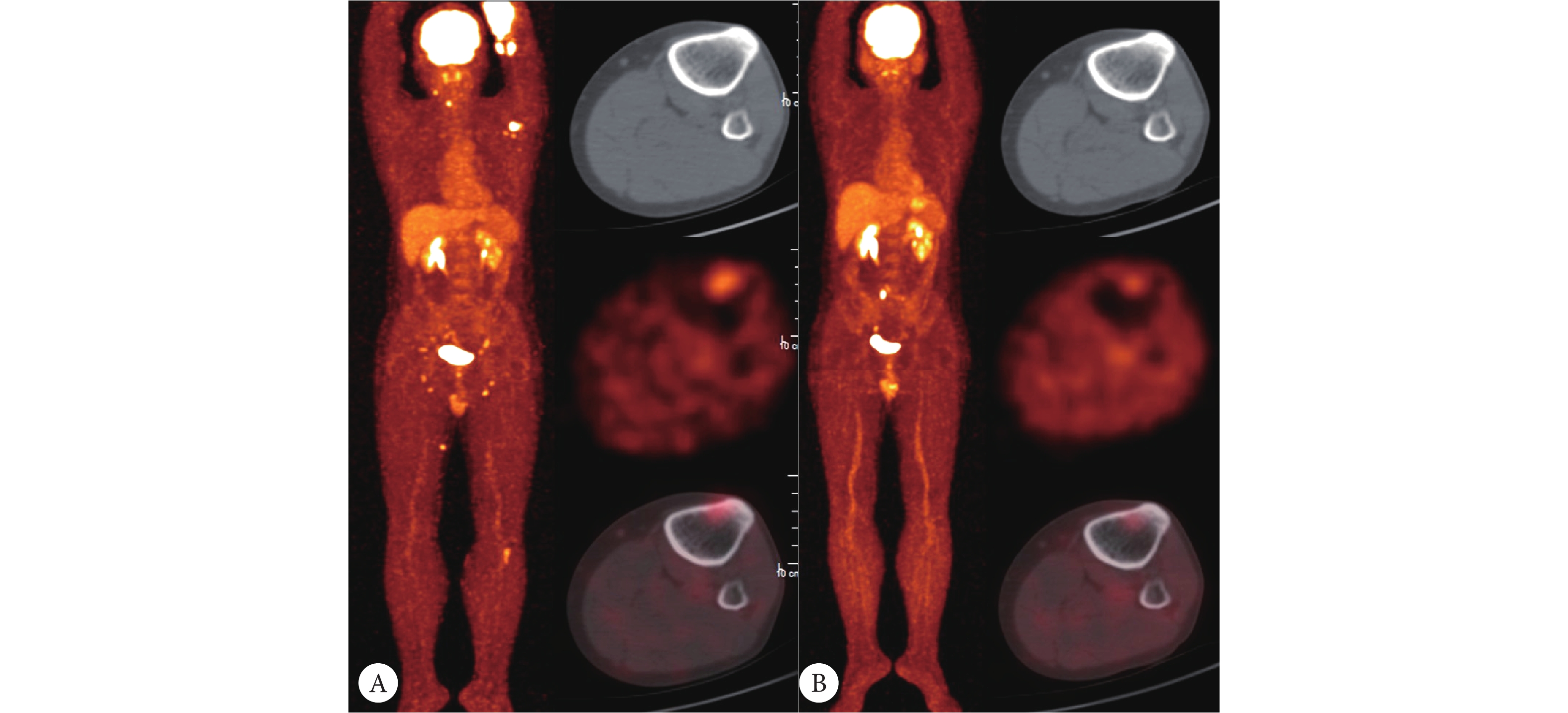 PET/CT真正全身显像在结外NK/T细胞淋巴瘤（鼻型）患者中的应用价值