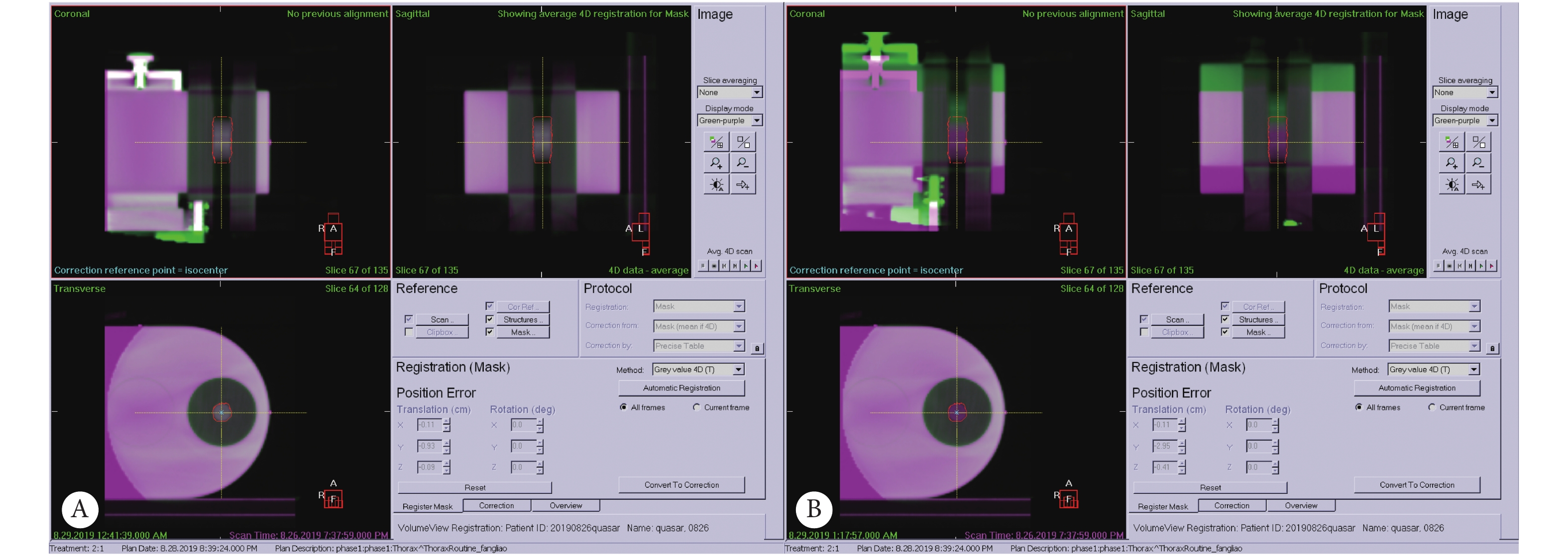 4D CBCT在胸部肿瘤影像引导下自动配准精度及其影响分析