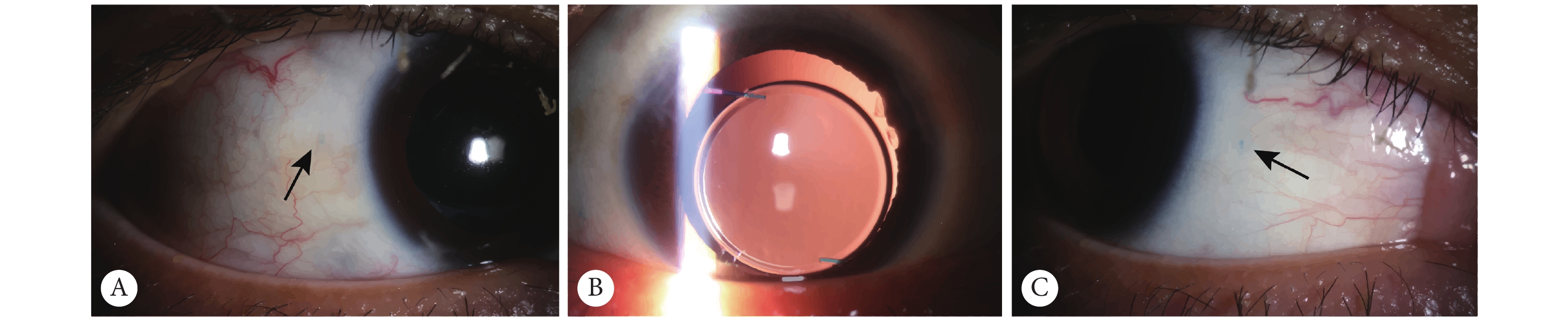 频域光学相干断层扫描观察改良YAMANE式后房型人工晶状体巩膜固定术的临床疗效