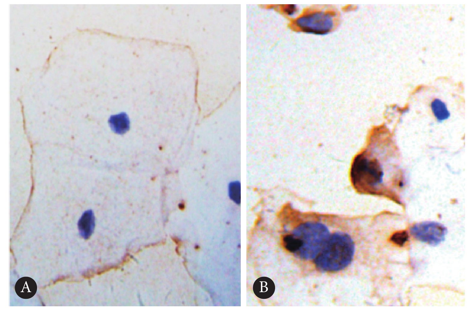 HPV L1/PD-L1检测联合阴道镜检查在宫颈癌前病变及宫颈癌中的临床意义