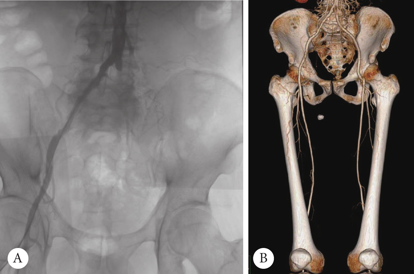Single-Center Experience of Treating Chronic Limb-Threatening Ischemia ...