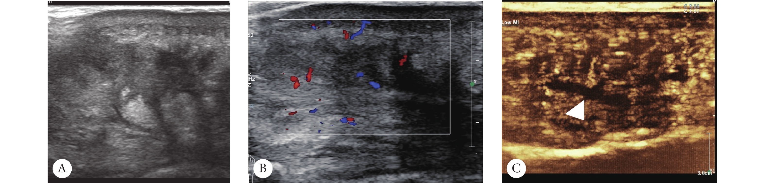 超声造影在糖尿病创面治疗中的临床应用