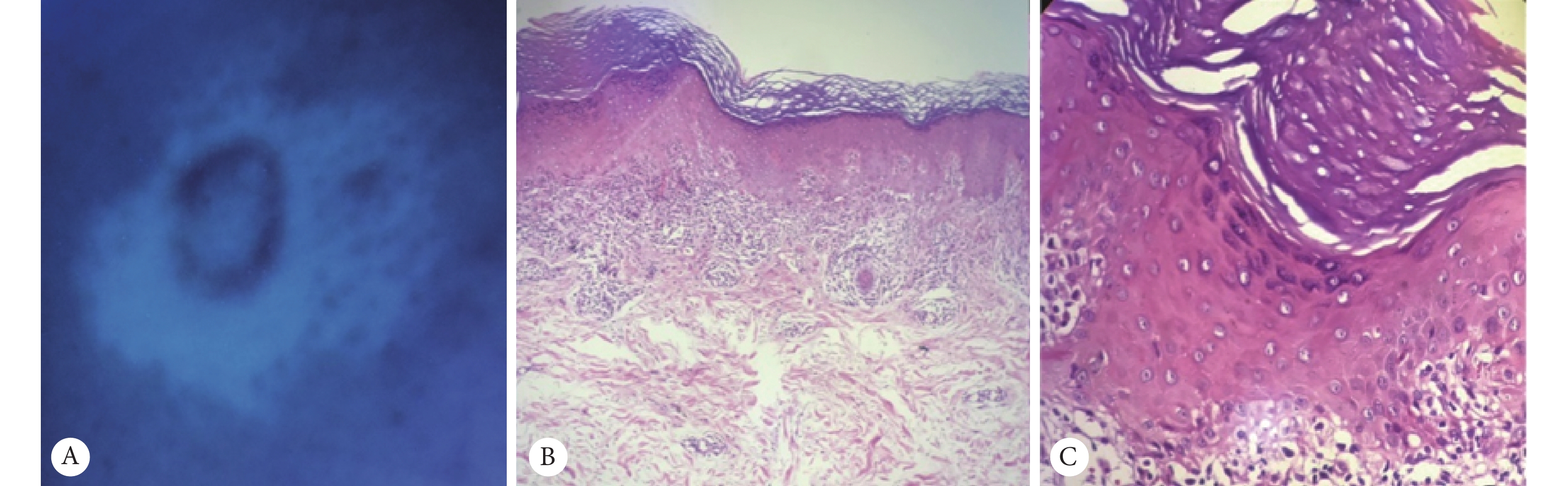 罕见白癜风并发环状扁平苔藓1例报告