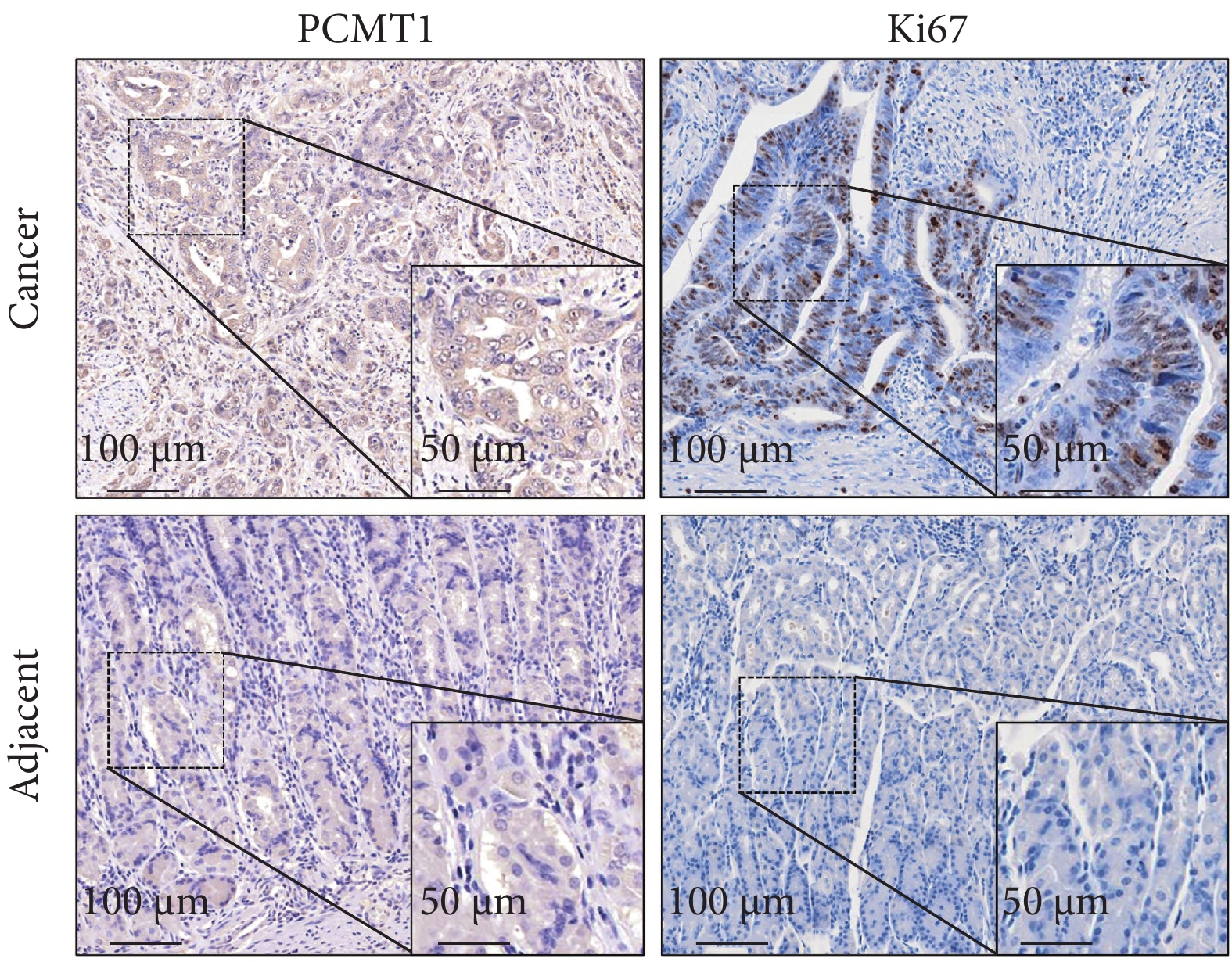 胃癌中PCMT1表达的预后价值及其对纺锤体组装检查点的调控作用